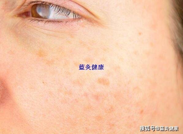 气滞血瘀应该如何调理气滞血瘀艾灸作用好不好妇科病