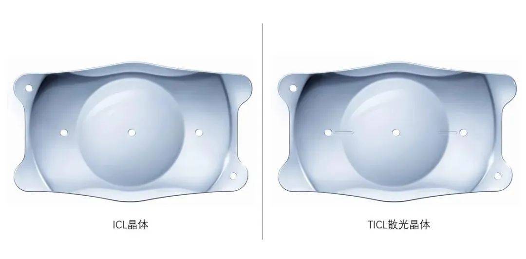 近视手术人工晶体植入ICL和TICL有什么区别？如何选择？_散光_度数_患者
