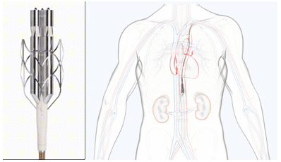 人工心脏5——一文浅析短期PVAD（下）_Impella_主动脉_导管