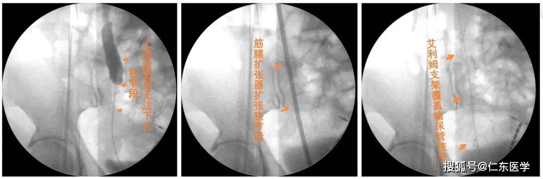 新华医院泌尿外科成功开展多例Allium输尿管支架植入术_患者_治疗_艾利姆