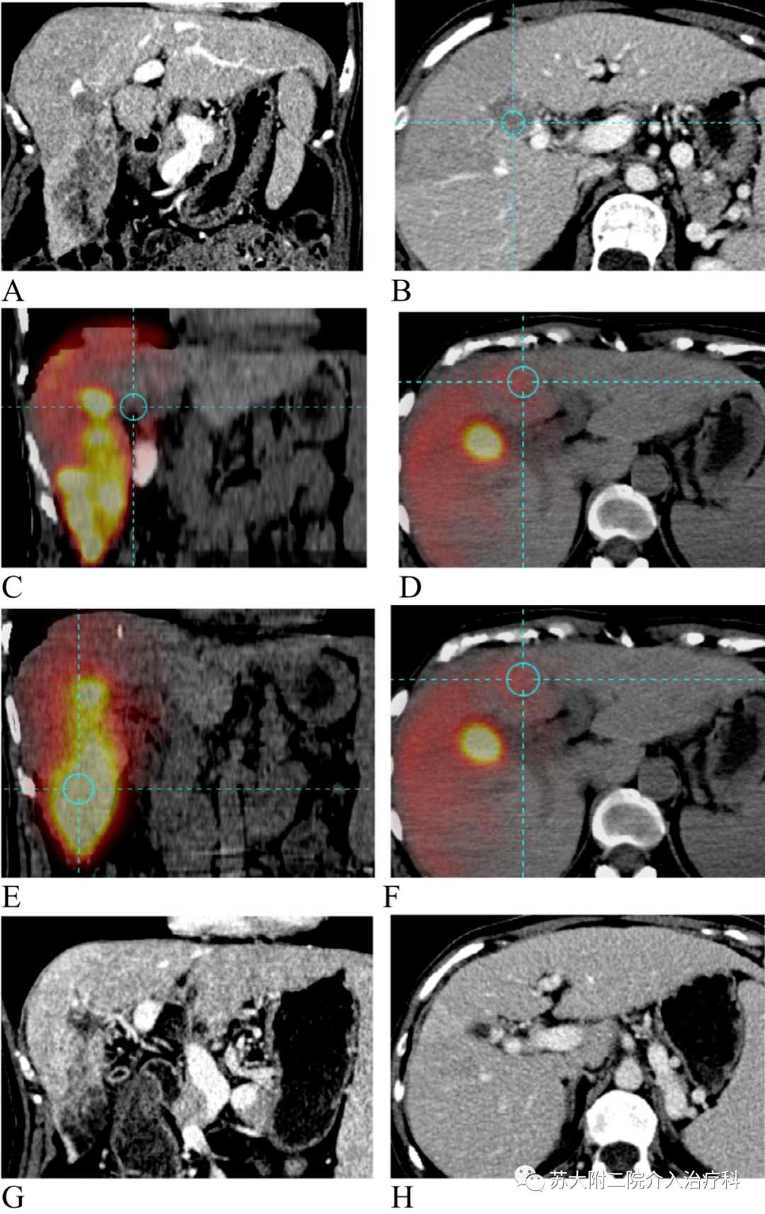 文献速递（第476期）—Y90微球SIRT治疗肝癌门脉癌栓：基于99mTc-MAA SPECT/CT的剂量法对临床的高度影响01_患者