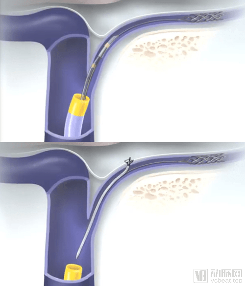 脑积水治疗设备的突破创新，帮助CereVasc斩获4390万美元A轮融资【海外案例】_eShunt