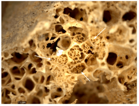 王红阳：靶向药物与免疫治疗有局限，肿瘤防控需前移-搜狐大视野-搜狐新闻