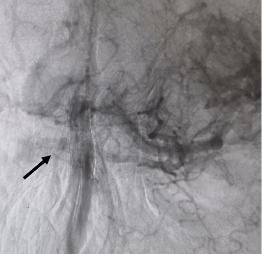 乘风破浪，豫美同行丨3D T1-SPACE联合3D-TOF MRA在Pipeline™治疗颅内动脉瘤术后随访中的应用_Primsa