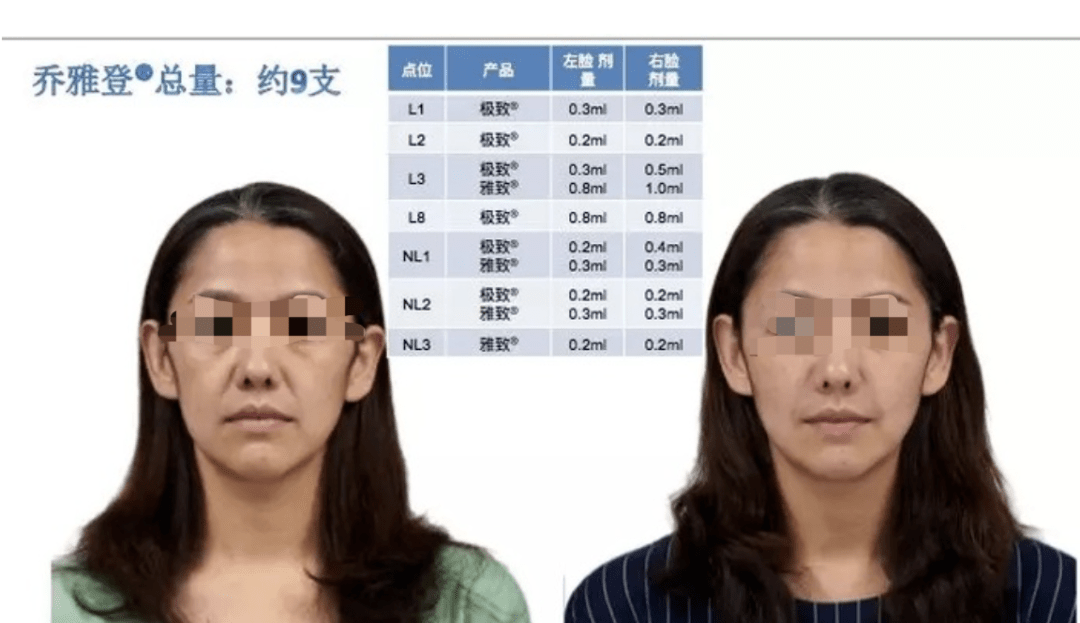 花姐说 |乔雅登MD Codes八点提升并不一定适合亚洲人。_定点