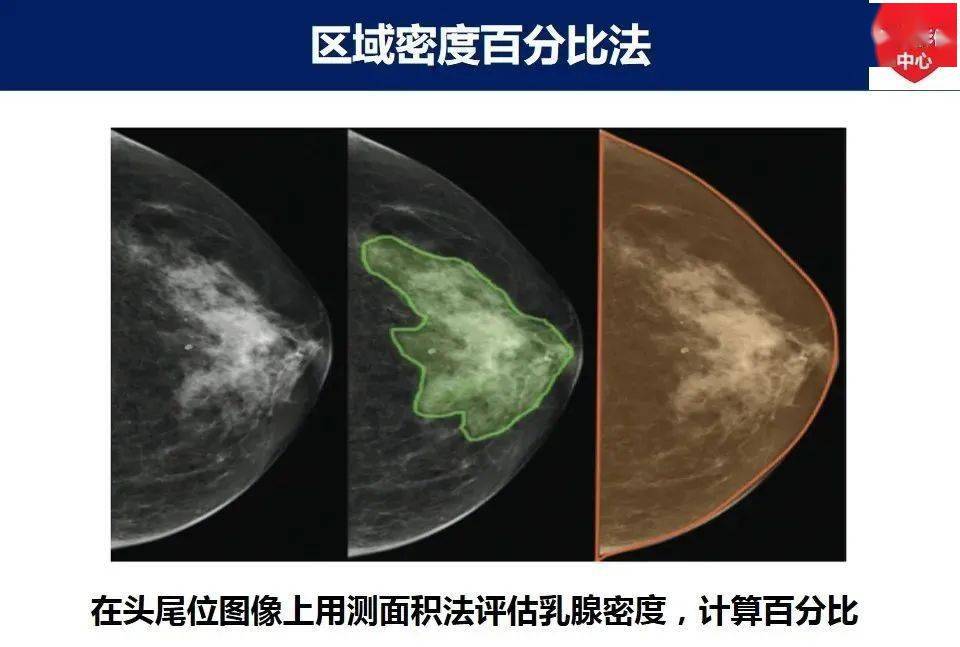 最新版乳腺x线 Bi Rads 分类解读检查