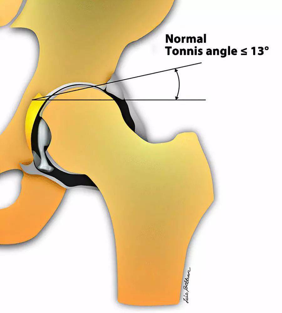 髋关节发育不良的影像学评价_测量