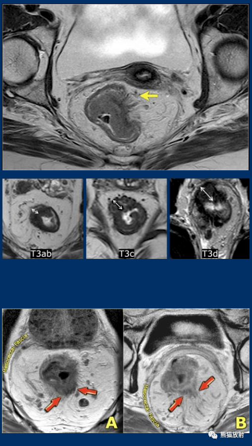 直肠癌MRI：精彩示例，易学易懂_括约肌