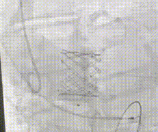 重磅｜启明医疗新一代球扩干瓣 Venus Vitae 全球首两例临床应用_瓣膜_mm_产品