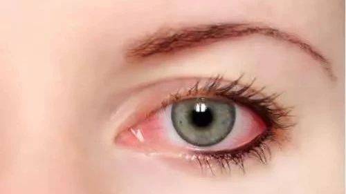 眼里经常出现红血丝，这些问题要注意！眼睛隐形眼镜企业