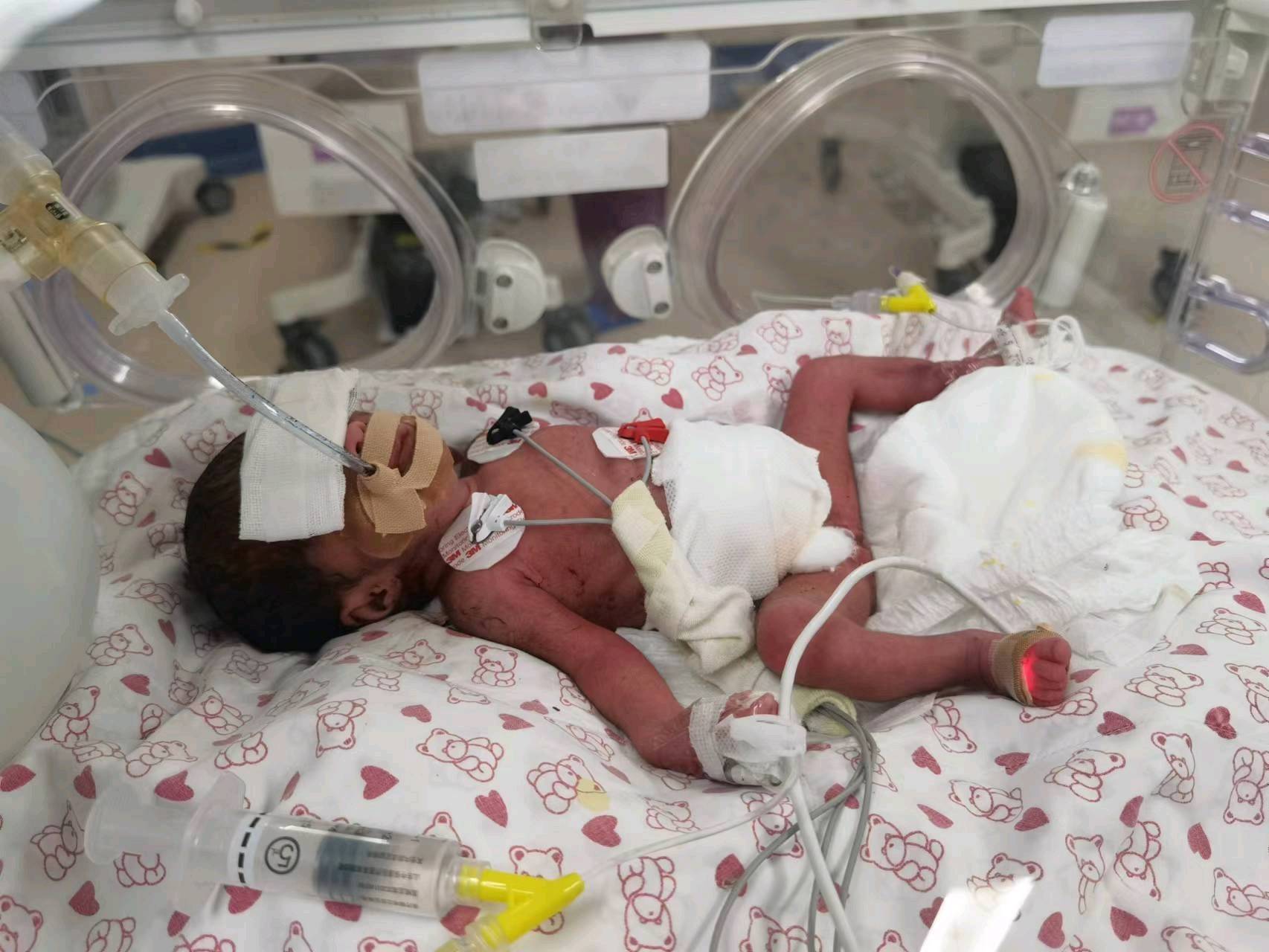 77个日夜的生命赛跑！出生仅巴掌大不足1公斤，珠海宝宝平安出院_体重_新生儿_救治