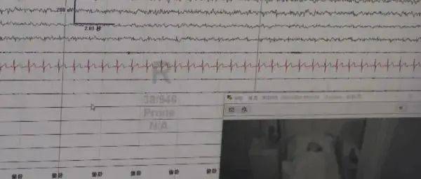 48秒就睡着,“秒睡”居然是一种病姜姜睡眠基因