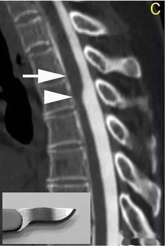 手术刀征：背侧蛛网膜网带_the_cord_of