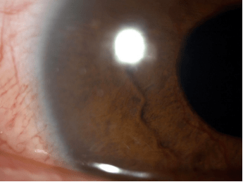 精彩疑例丨白内障术后虹膜新生血管急性发作一例_检查_hemi-CRVO_手术