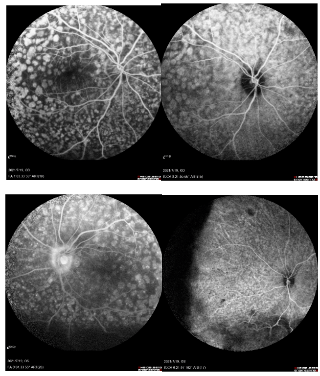 Retina China 2022丨王毓琴教授：罕见病例分享——双眼弥漫性葡萄膜黑色素细胞增生_患者_视网膜_肿瘤
