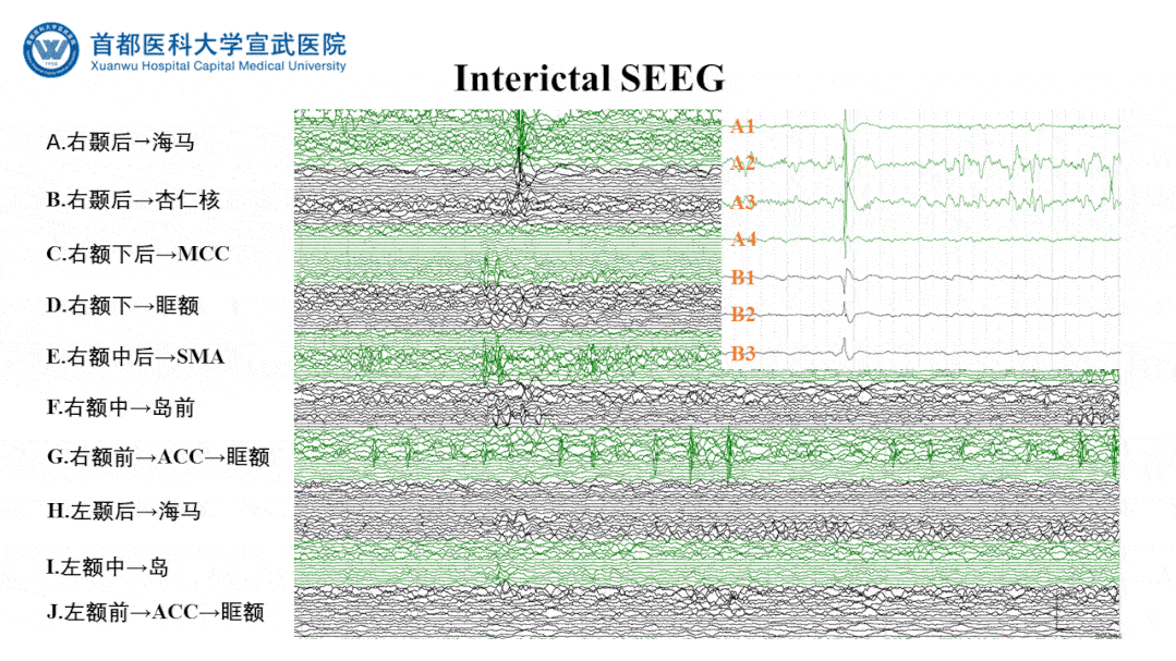 华科在线｜专访宣武医院乔梁：手术机器人无死角操作优势与SEEG经验_电极_应用