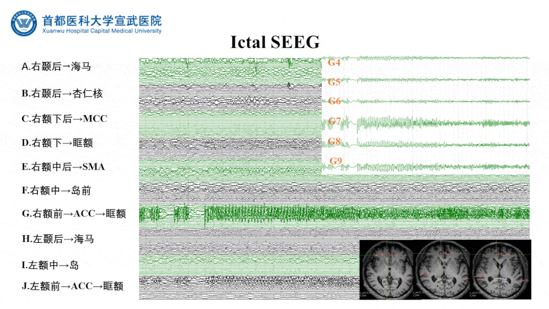 华科在线｜专访宣武医院乔梁：手术机器人无死角操作优势与SEEG经验_电极_应用