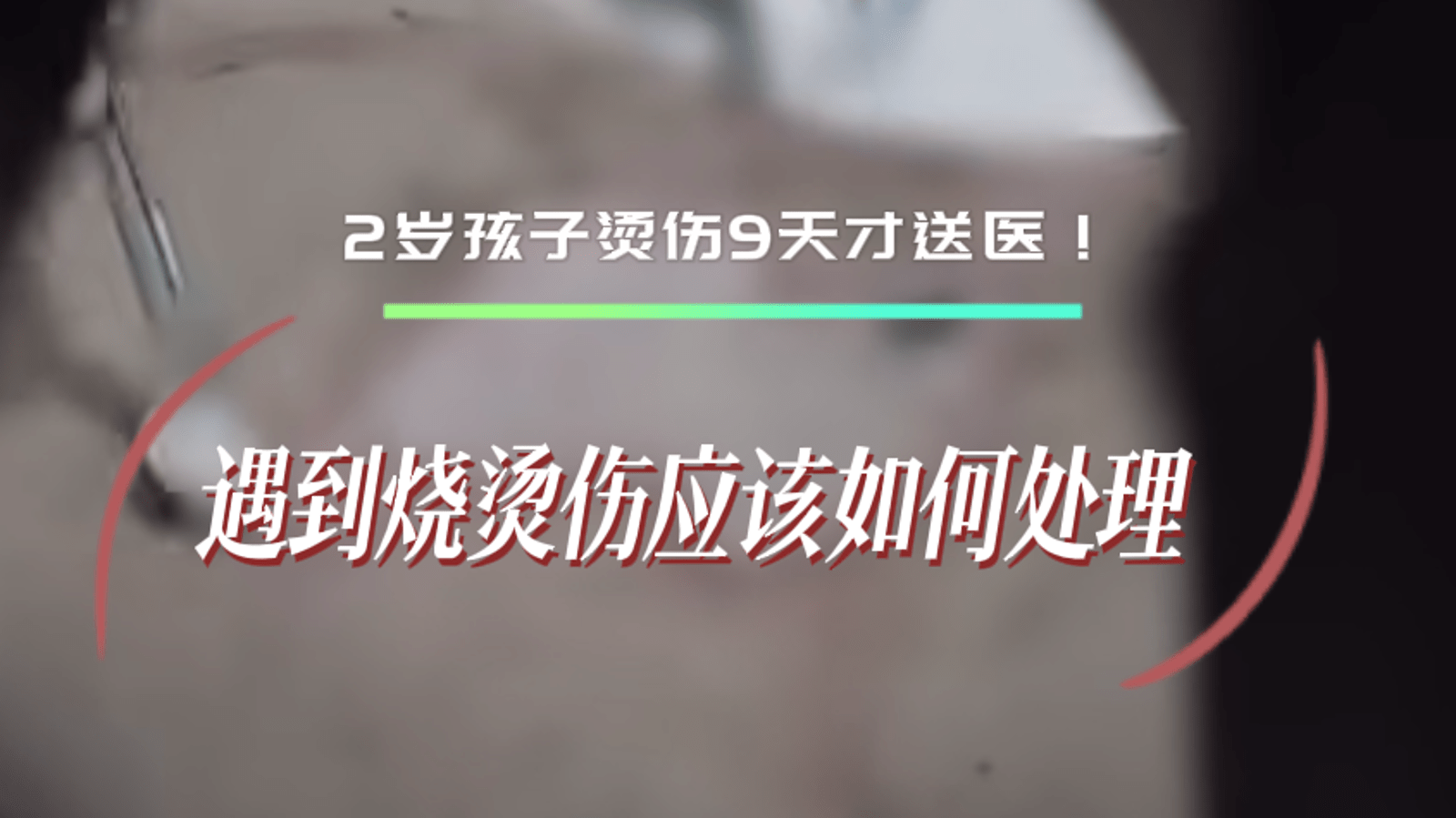 2岁孩子烫伤9天才送医！遇到烧烫伤我们应该如何处理_医生_严重_创面