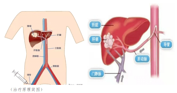晚期肝癌治疗新选择：肝动脉灌注化疗（HAIC）——让化疗药物直捣黄龙_血管_腹腔镜_门静脉